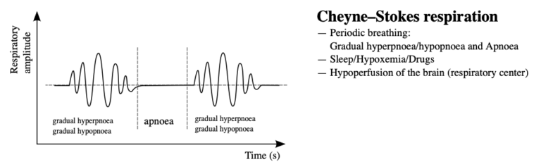 Cheyne-Stokes 呼吸 | メディカルチャート